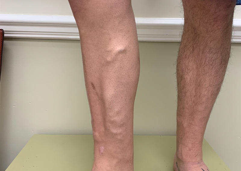 Podiatric Vein Care - Using the Vein Roadmap Analogy to Understand Vein ...