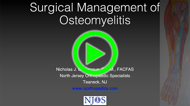 This Just In... - Surgical Management of Osteomyelitis