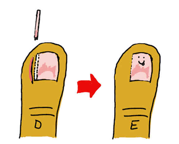 Practice Perfect 885 - Don’t Do Nail Avulsions